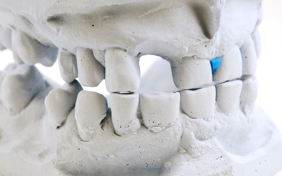 Bone Regeneration With Hydrogel